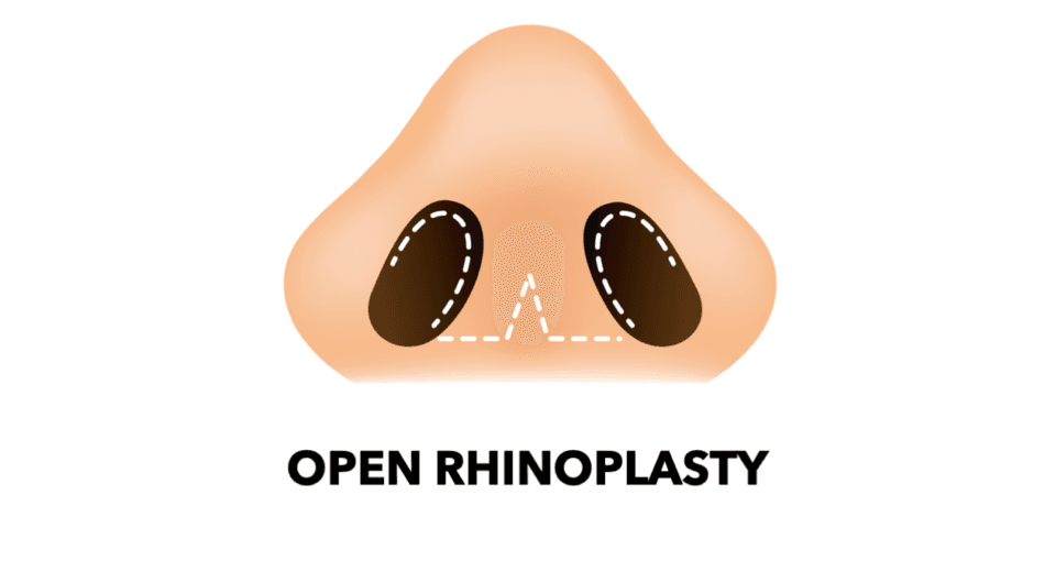 Rhinoplasty - 365Sehat