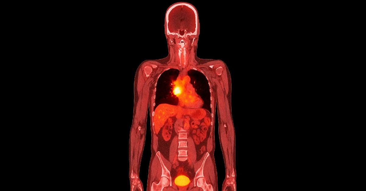 PET/CT Scan Kanker Paru - Untuk Deteksi Kanker Paru Sedini Mungkin ...